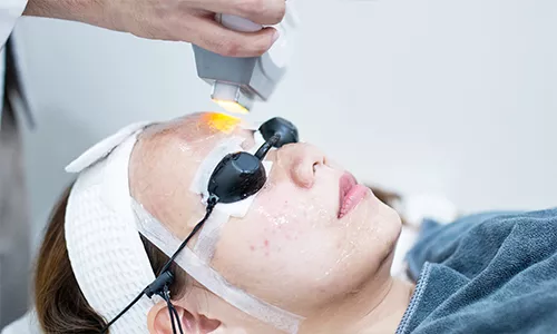 V-IPL Laser | ลดสิว กระชับรูขุมขน ผิวใสไร้รอยแดง