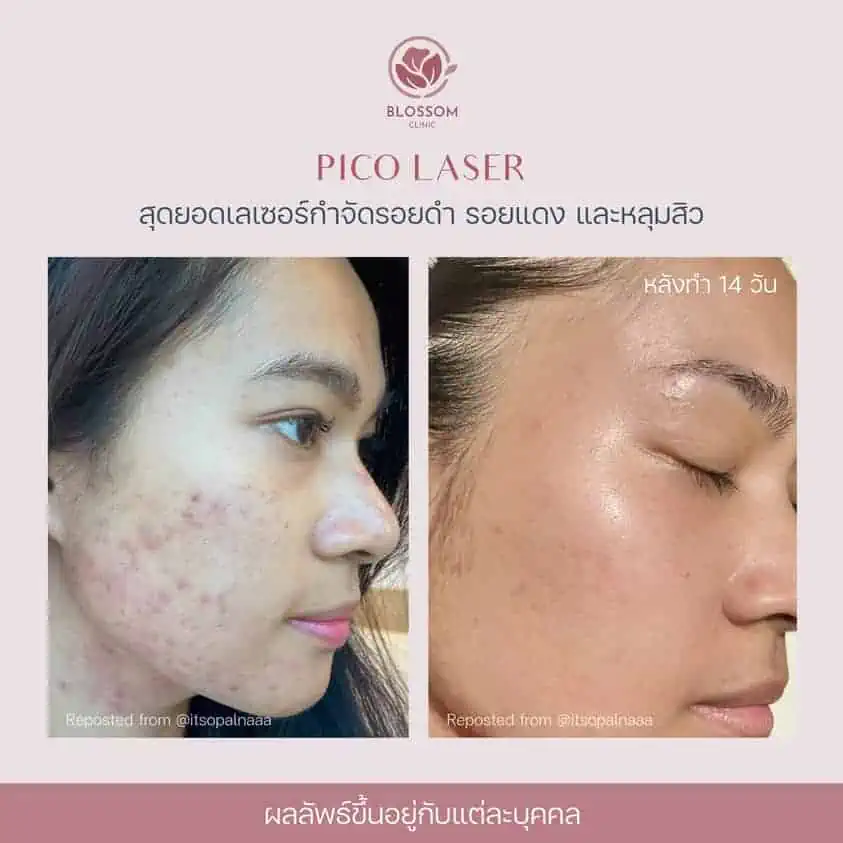 Pico Laser คืออะไร ทำไมถึงยอดนิยม? ลดกระ ฝ้า ที่ blossomclinic