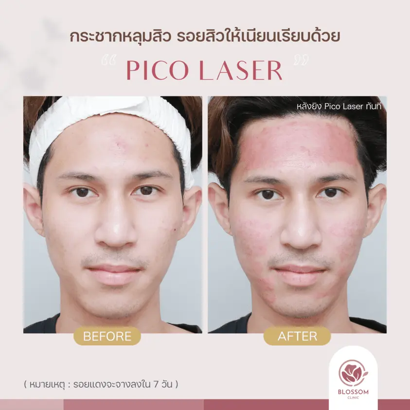 Pico Laser คืออะไร ทำไมถึงยอดนิยม? ลดกระ ฝ้า ที่ blossomclinic