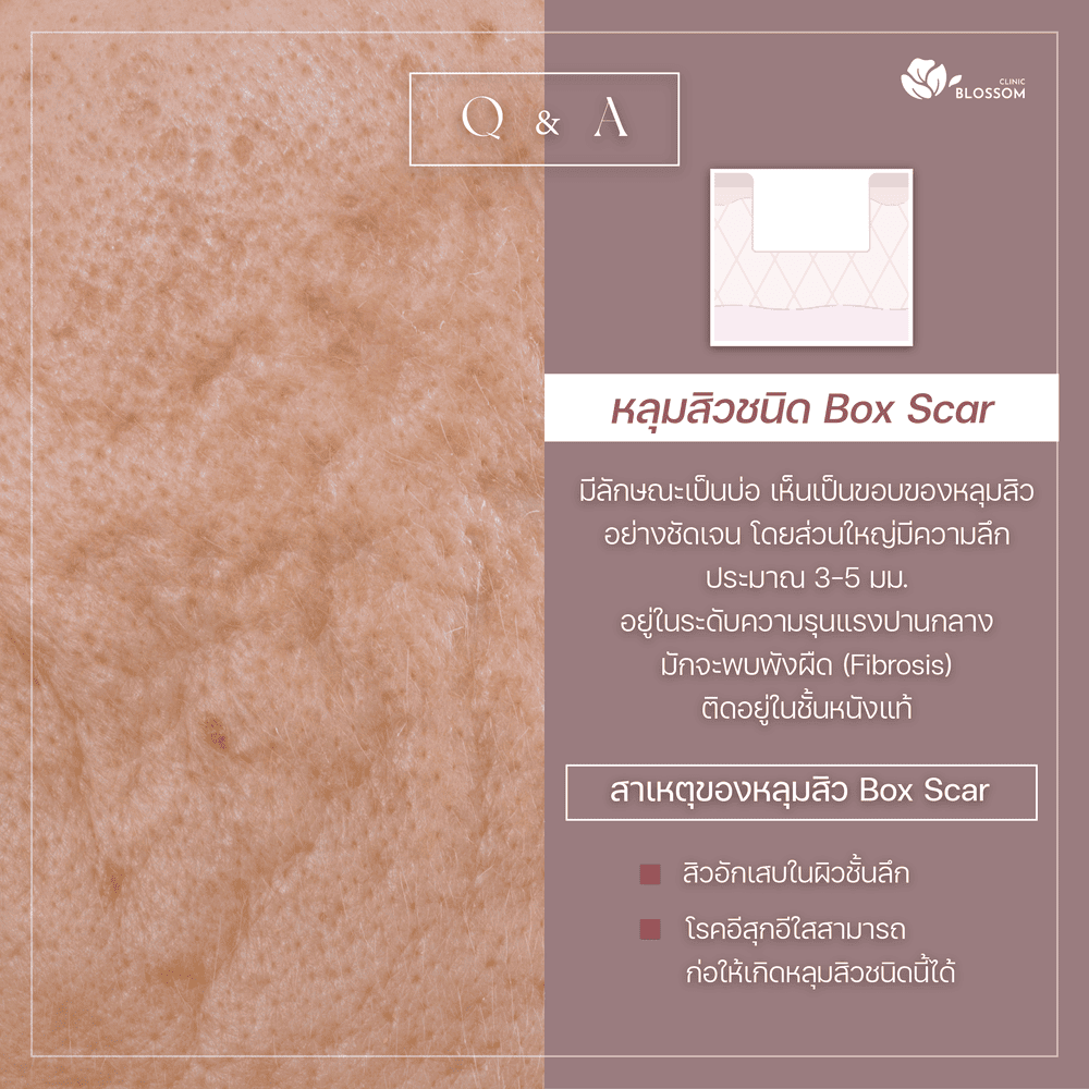 Q & A เรื่อง หน้าเป็นหลุมสิว รักษาอย่างไรให้หายขาด?