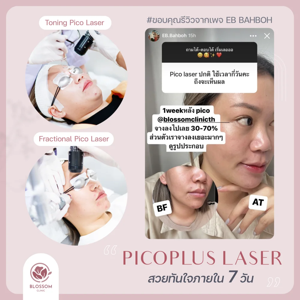 Pico Laser คืออะไร ทำไมถึงยอดนิยม? ลดกระ ฝ้า ที่ blossomclinic